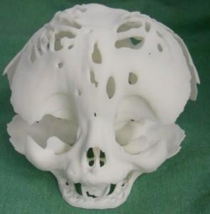 3D Printing Saves the Life of a Newborn with Cloverleaf Skull Syndrome ...