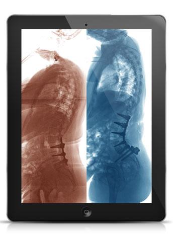 3D Technology Allows MEDICREA to Create New FDA-Approved Spinal ...