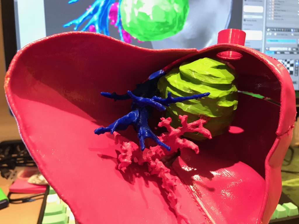 Medical Student Creates Patient-Specific 3D Printed Liver Model for ...
