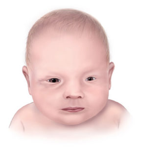 3D Printed Eye Prostheses Can Help Children with Missing or ...