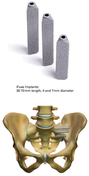 First 3D Printed Titanium Implant for the Sacroiliac Joint, the iFuse ...