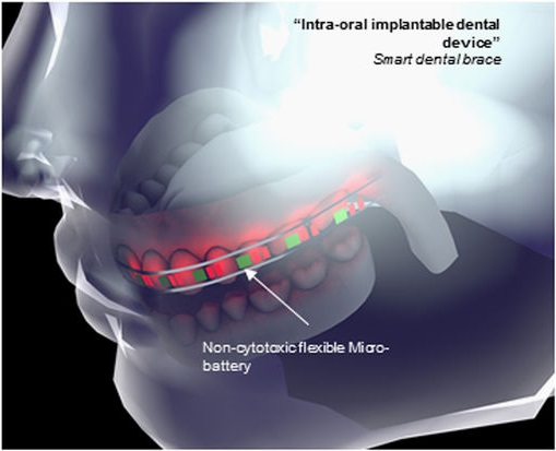3D Printed Braces Incorporate Flexible Electronics for Faster Healing ...