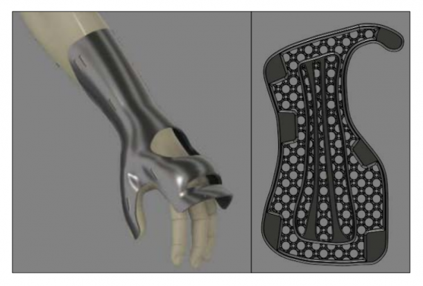 3D Printed Splints & Braces: Just As Effective & Comfortable, Cheaper ...