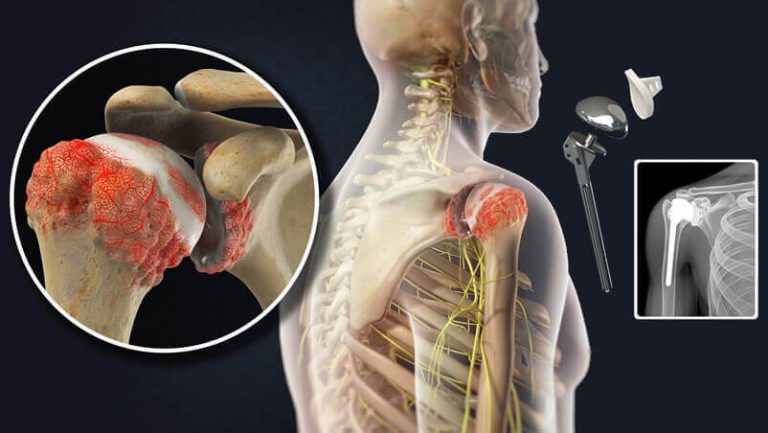 VA Takes On Shoulder Surgery Using 3D Printed Models - 3DPrint.com ...