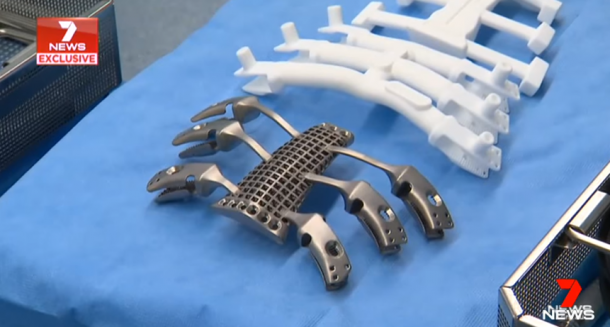 Australian Man Receives 3D Printed Titanium Replacement for Sternum ...