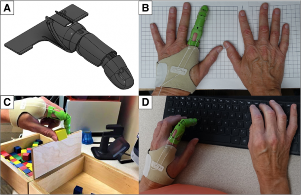 Case Study: A 3D Printed Patient Specific Partial Finger Prosthesis ...