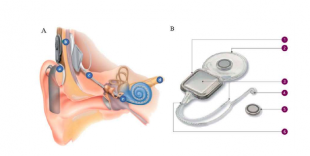 University of Wollongong: Refining the Cochlear Implant with 3D ...