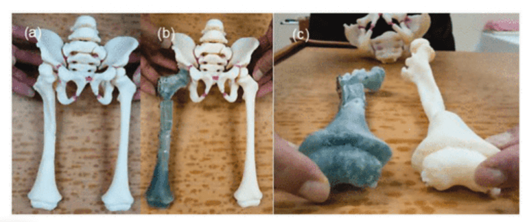 hip deformity Archives - Perfect 3D Printing Filament