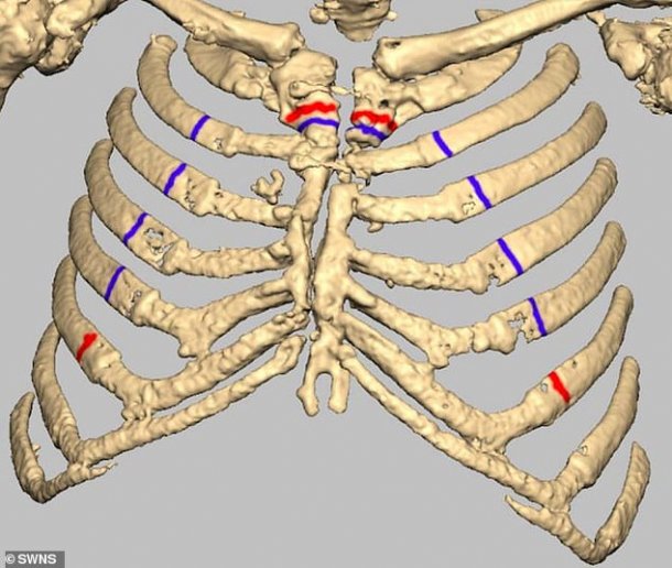 UK Heart Patient Undergoes Rare Surgery for 3D Printed Titanium Sternum ...