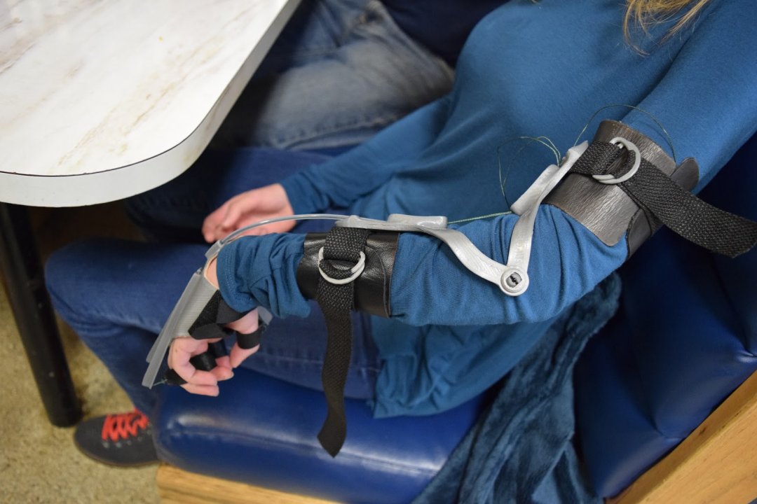 Enabling the Future: 3D Printed Frog Arm Prosthetic for Epilepsy ...