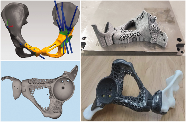 3D Printed Guide and Titanium Implant Help Surgeons Reconstruct Patient ...