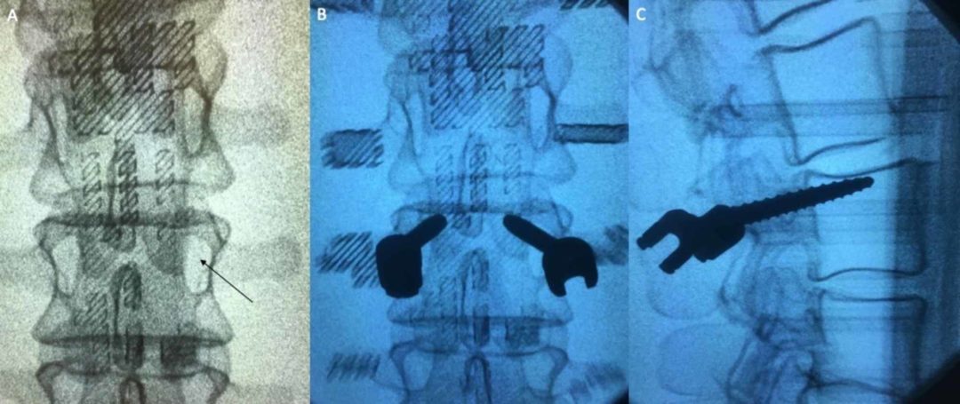 Mayo Clinic Creates Free 3D Printed Spine Surgery Simulator for Medical ...