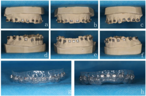 Comparing 3D-Printed and Traditional Guide Plates for Placing ...