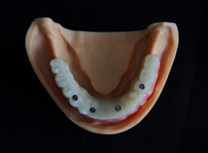 AMS Speaker Spotlight: Designing and Metal 3D Printing a Dental Implant ...