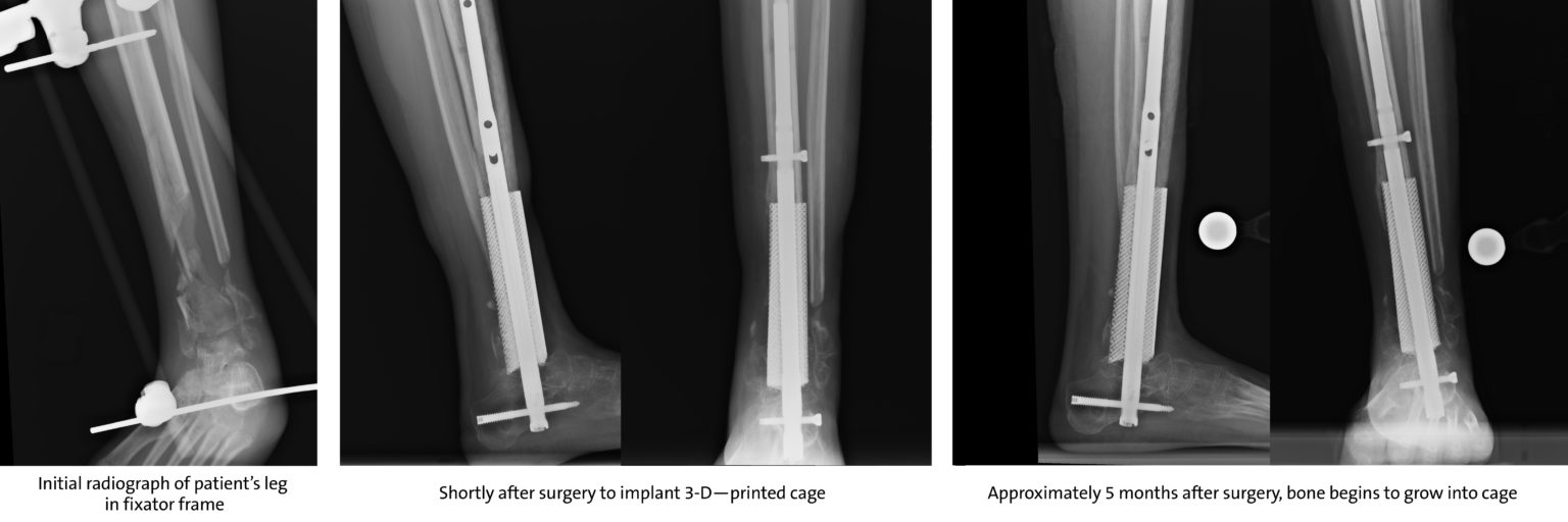$23M Funding Round to Expand 3D Printed Surgical Solutions from ...