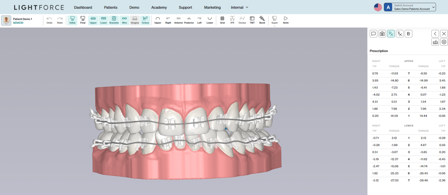 LightForce Orthodontics Snags $80M for 3D Printed Braces Expansion; Plans Hiring Spree - 3DPrint ...