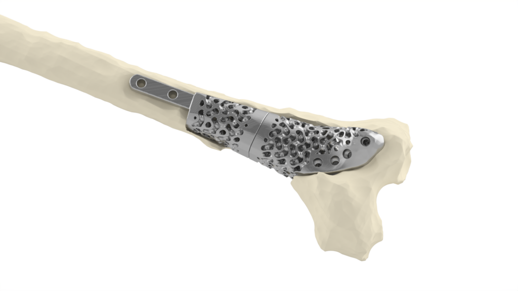 Thai Startup OsseoLabs to Cut Surgery Time with 3D Printed Magnesium ...