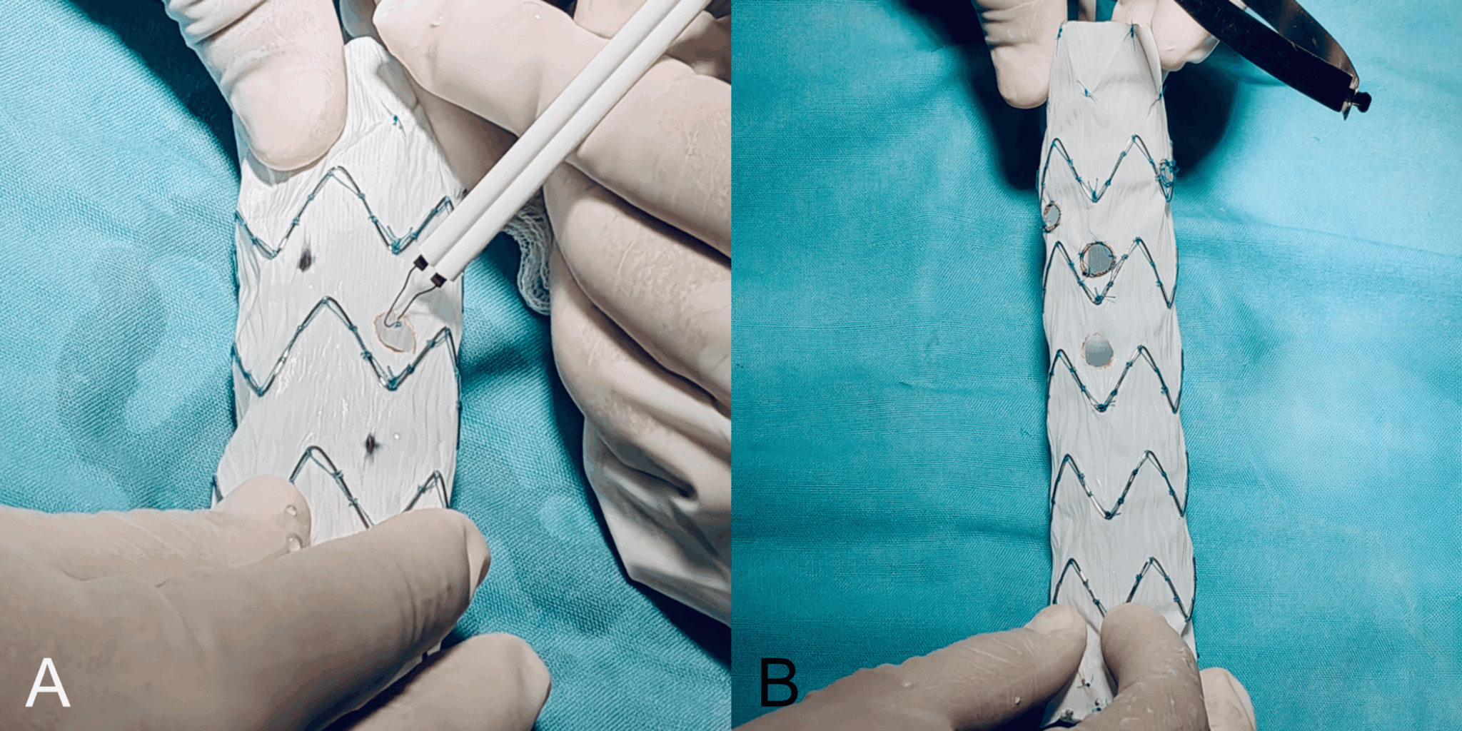 Surgeons Test Fast, Low-Cost 3D Printed Template to Improve Custom ...