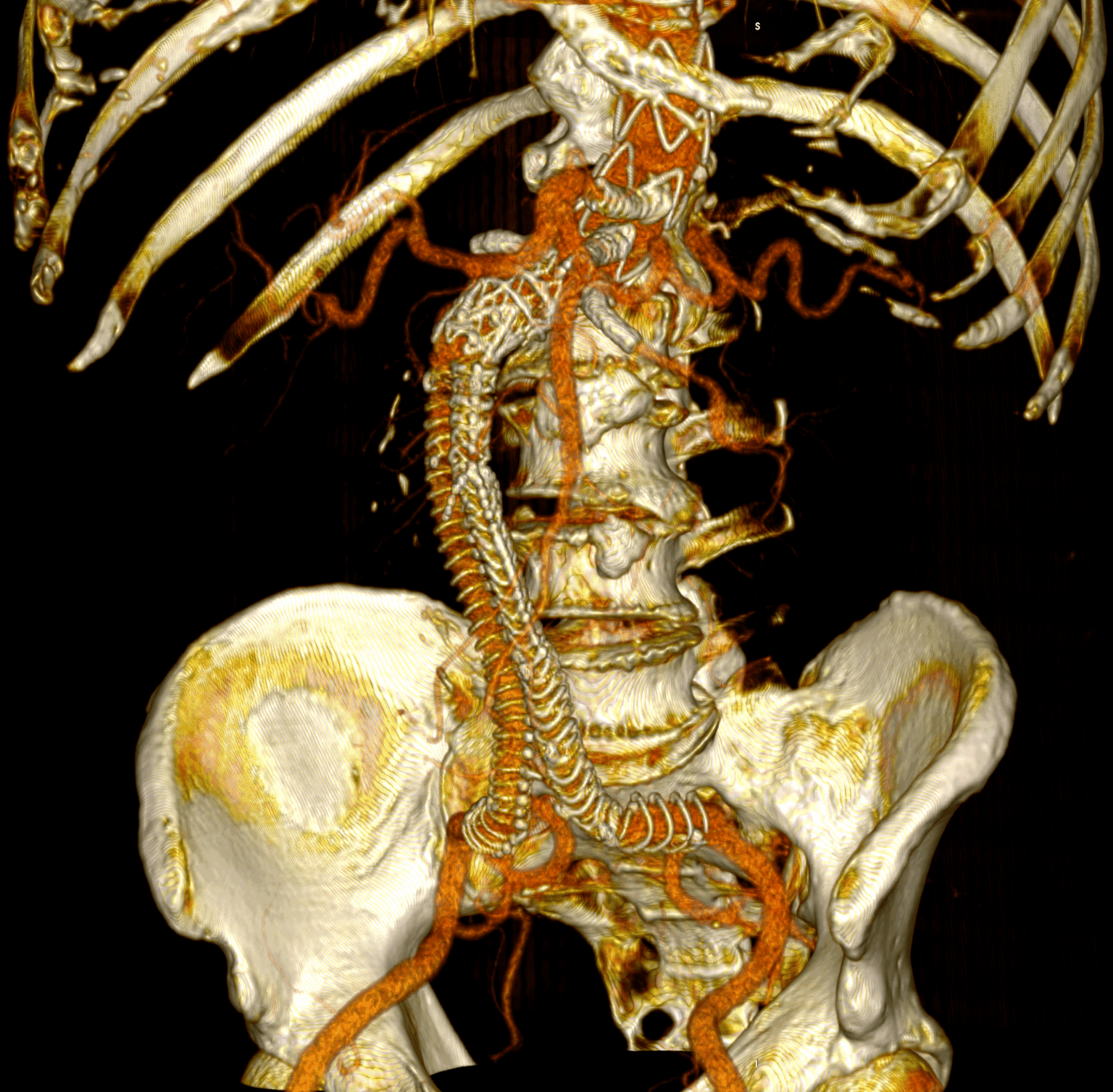 Surgeons Test Fast, Low-Cost 3D Printed Template to Improve Custom ...